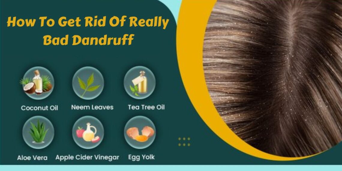 How To Get Rid Of Really Bad Dandruff | Treatments And Remedies